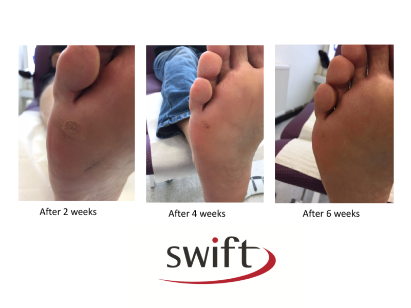 Swift Treatment for Stubborn Verruca's - Before and After - The ...